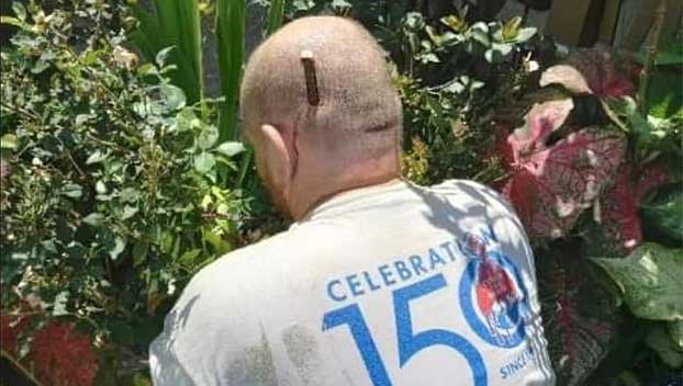 Nederland man talks about being impaled in head by rebar – “If you love ...